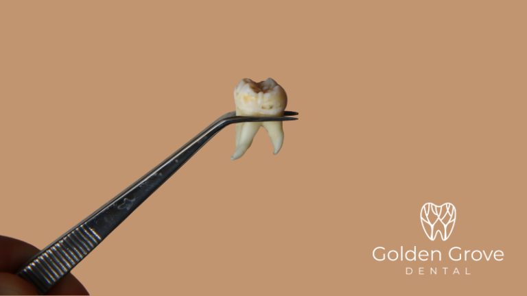 How to Manage a Decayed Wisdom Tooth?
